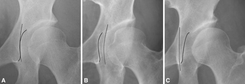 Does Radiographic Coxa Profunda Indicate Increased Acetabular Coverage ...