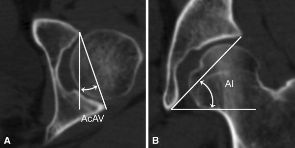 Does Radiographic Coxa Profunda Indicate Increased Acetabular Coverage ...