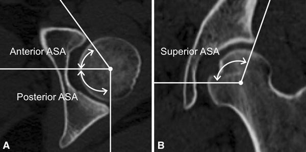 Does Radiographic Coxa Profunda Indicate Increased Acetabular Coverage ...