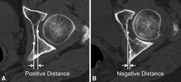 Does Radiographic Coxa Profunda Indicate Increased Acetabular Coverage ...