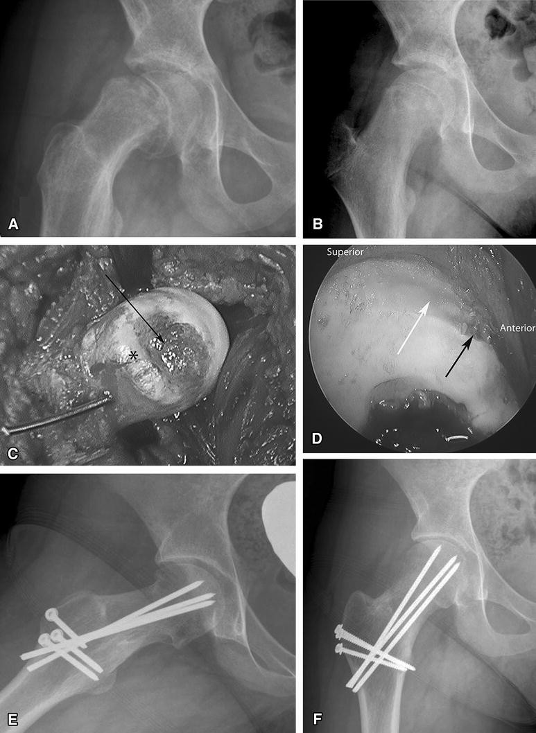 Modified Dunn Procedure is Superior to In Situ Pinning for Short-term ...
