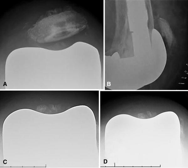 What Is the Role for Patelloplasty With Gullwing Osteotomy in Revision ...