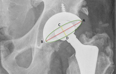 What Safe Zone? The Vast Majority of Dislocated THAs Are Within the ...