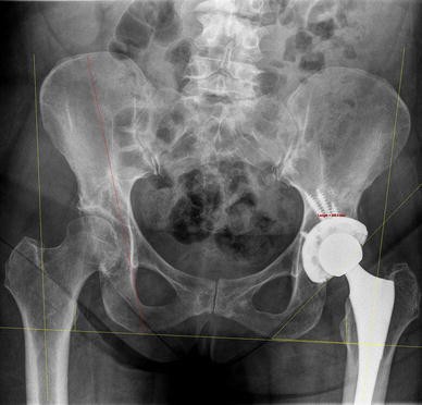 What Safe Zone? The Vast Majority of Dislocated THAs Are Within the ...