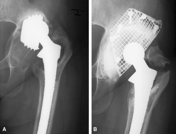 THA Revisions Using Impaction Allografting With Mesh Is Durable for ...