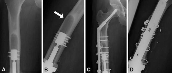 Revision Distal Femoral Arthroplasty With the Compress® Prosthesis Has ...