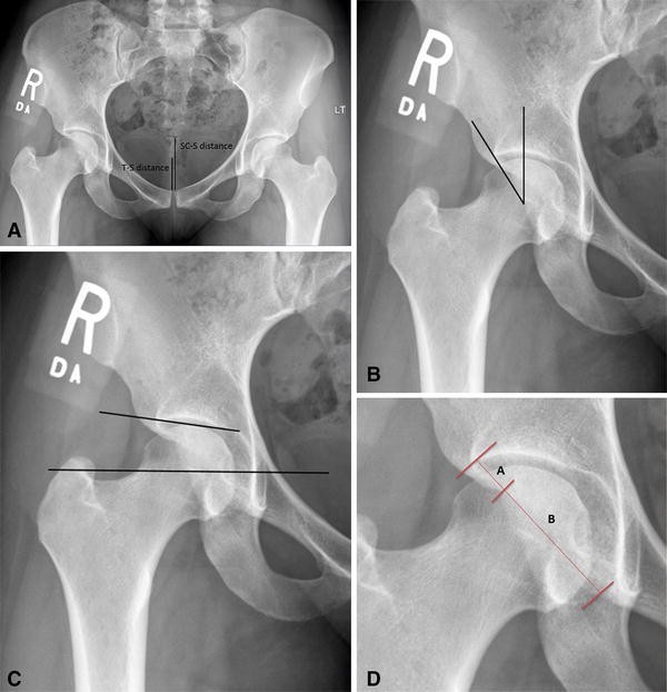 Supine and Standing AP Pelvis Radiographs in the Evaluation of Pincer ...