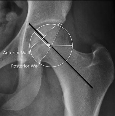 Acetabular Wall Indices Help to Distinguish Acetabular Coverage in ...