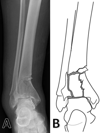 Classifications in Brief: Rüedi-Allgöwer Classification of Tibial ...