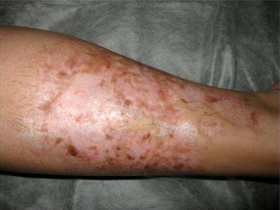 Autoinflammatory Skin Disorders in Inflammatory Bowel Diseases ...