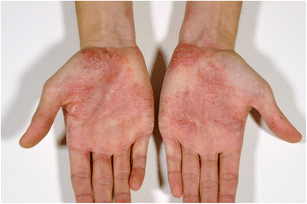 Skin Manifestations of Inflammatory Bowel Disease | SpringerLink