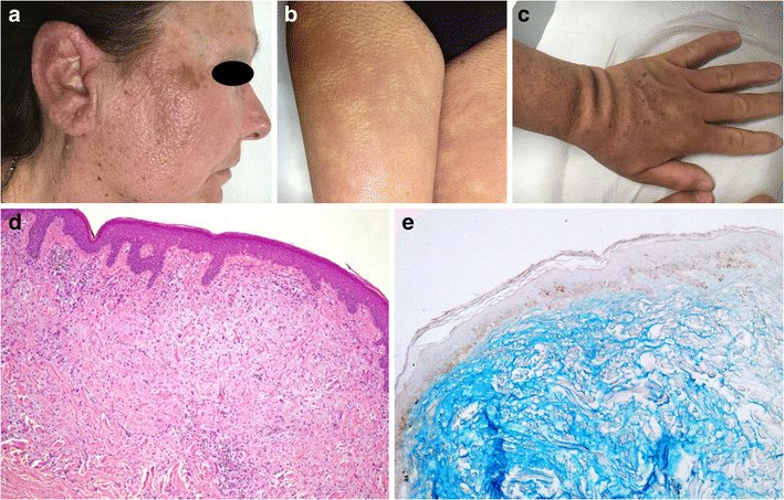 Cutaneous Manifestations of Scleroderma and Scleroderma-Like Disorders ...