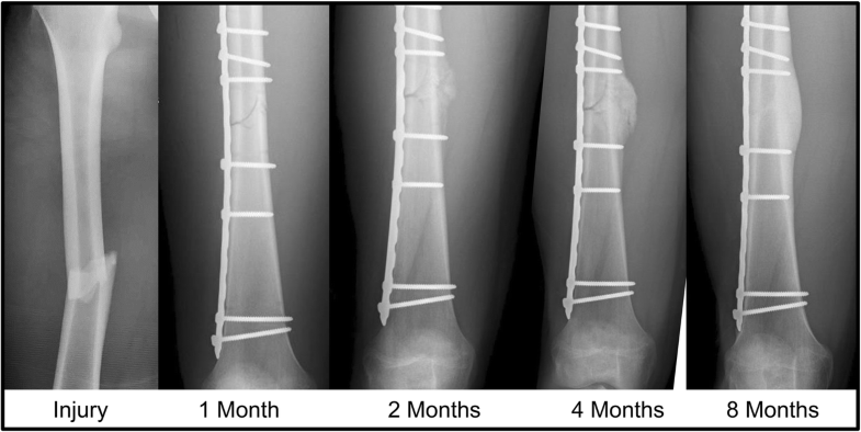 Bone Fracture Acute Phase Response—A Unifying Theory of Fracture Repair ...