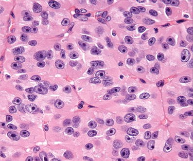 Oncocytes, Oxyphils, Hürthle, and Askanazy Cells: Morphological and ...