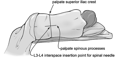 Lumbar drainage for subarachnoid hemorrhage: technical considerations ...