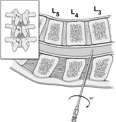 Lumbar drainage for subarachnoid hemorrhage: technical considerations ...