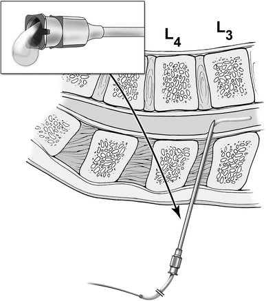 Lumbar drainage for subarachnoid hemorrhage: technical considerations ...