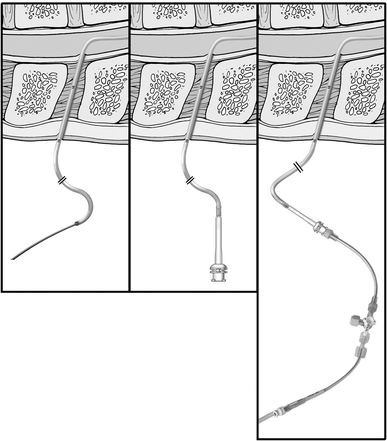 Lumbar drainage for subarachnoid hemorrhage: technical considerations ...