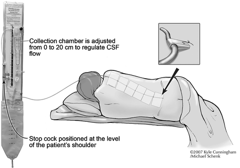 Lumbar drainage for subarachnoid hemorrhage: technical considerations ...