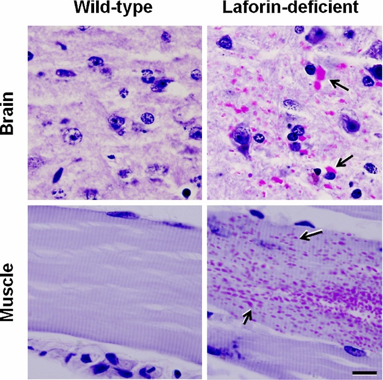 Lafora disease: from genotype to phenotype | SpringerLink