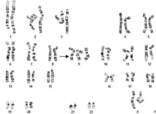 Mosaic Trisomy 9 Presenting with Congenital Heart Disease, Facial ...