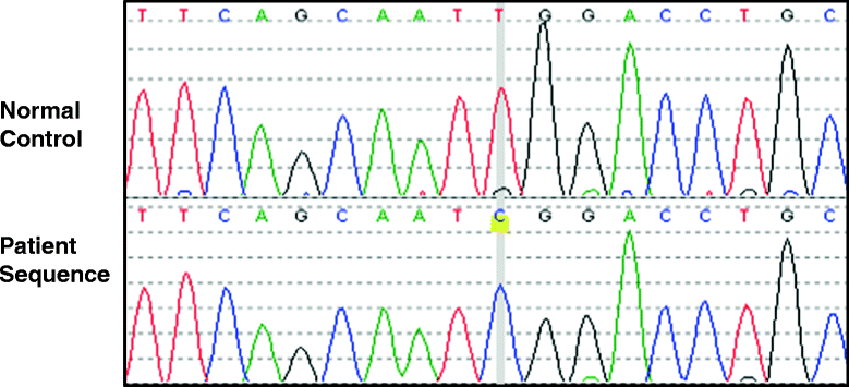 Fanconi-Bickel Syndrome - Mutation in SLC2A2 Gene | SpringerLink