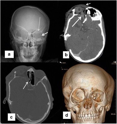 Bare Orbit Sign: Classical Sign in Cranio-orbital-temporal ...