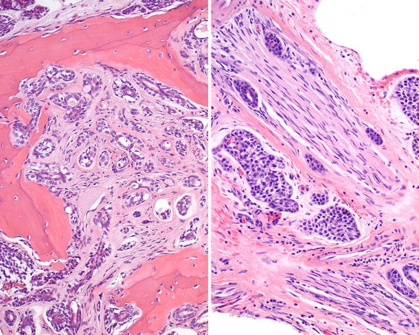 Sinonasal Tract Adenoid Cystic Carcinoma Ex-Pleomorphic Adenoma: A ...