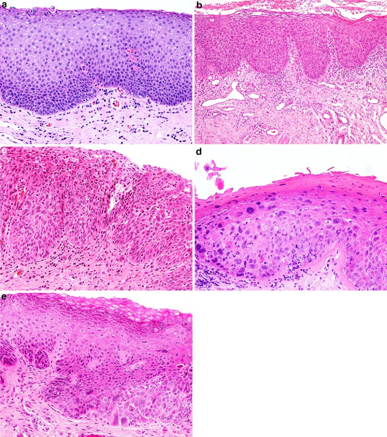 Update from the 4th Edition of the World Health Organization ...