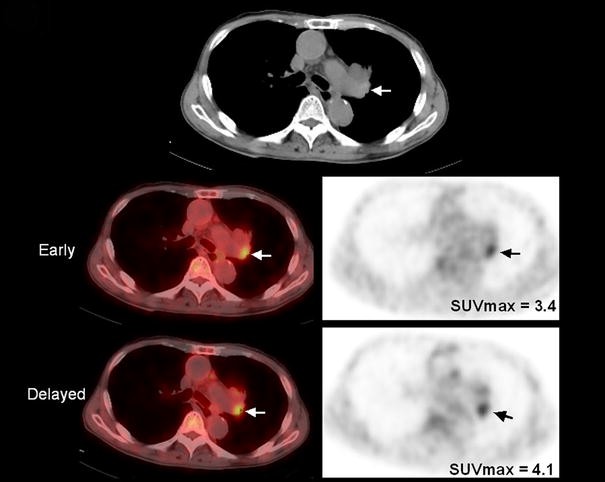 Differential diagnosis between 18F-FDG-avid metastatic lymph nodes in ...
