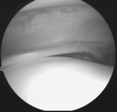 Medial plica irritation: diagnosis and treatment | SpringerLink