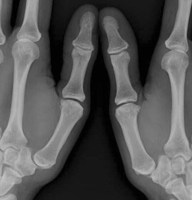 Arthritis of the base of the thumb | SpringerLink