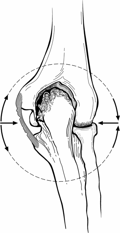 Elbow medial collateral ligament injuries | SpringerLink