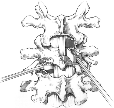Comparison of low back fusion techniques: transforaminal lumbar ...