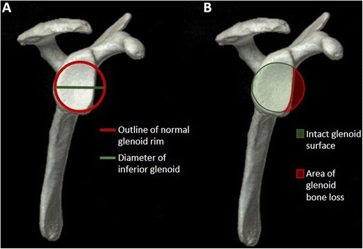 Management of Glenoid Bone Loss with Anterior Shoulder Instability: Indications and Outcomes ...