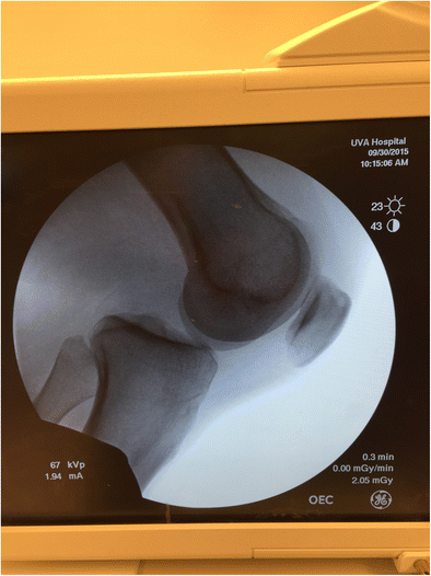Revision PCL Reconstruction Review/Update | SpringerLink