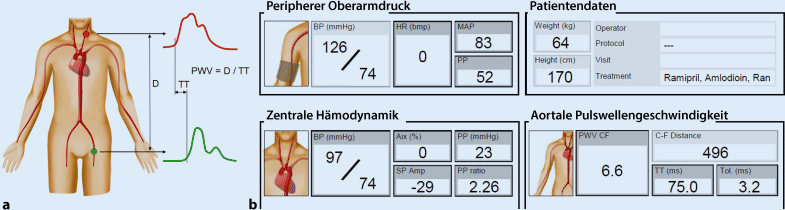 Arterielle Gefäßsteifigkeit – Ursachen und Konsequenzen | SpringerLink