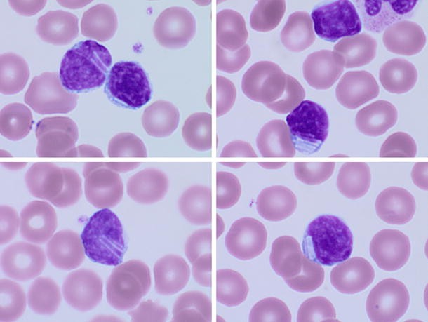 CLL with intra-cytoplasmic lymphocytic inclusion bodies | SpringerLink