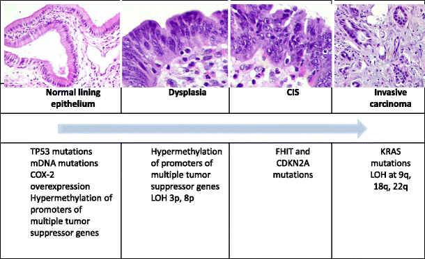 Pathology of Gallbladder Carcinoma: Current Understanding and New ...