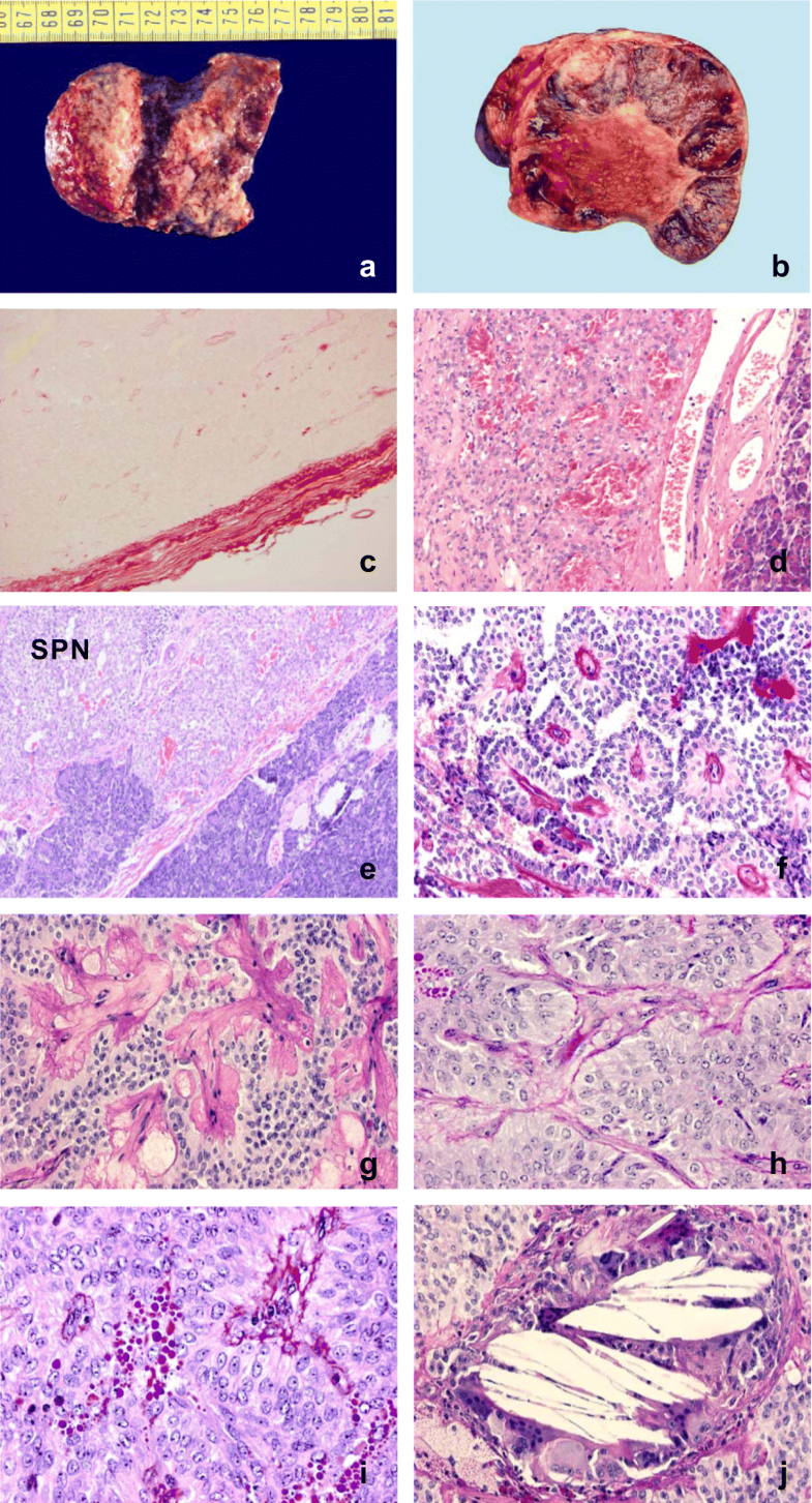 Solid-pseudopapillary Neoplasms of the Pancreas is still an Enigma: a ...