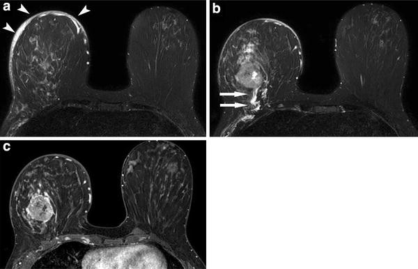 Focal breast edema associated with malignancy on T2-weighted images of ...