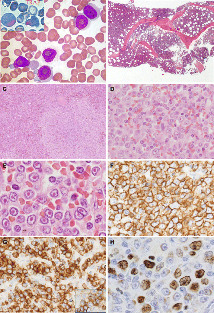 Hairy cell leukemia variant | SpringerLink