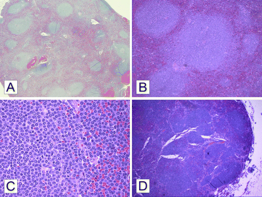Splenic marginal zone lymphoma with t(8;14)(q24.1;q32)/MYC ...