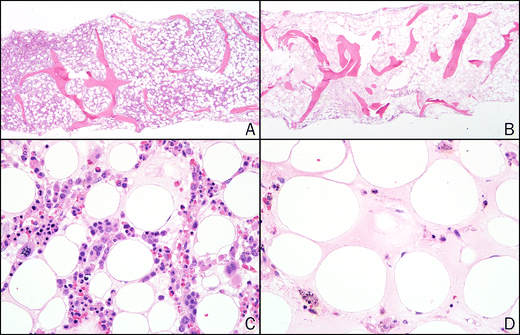 Pancytopenia with focal serous atrophy (gelatinous transformation) of ...