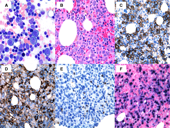 Bone marrow manifestation of plasmablastic transformation of chronic ...