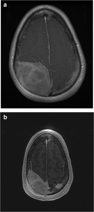 Primary dural lymphoblastic B-cell lymphoma: a rare subtype of ...