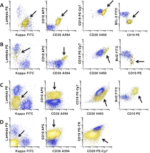 Significance of CD10-positive clonal B cell populations identified by ...