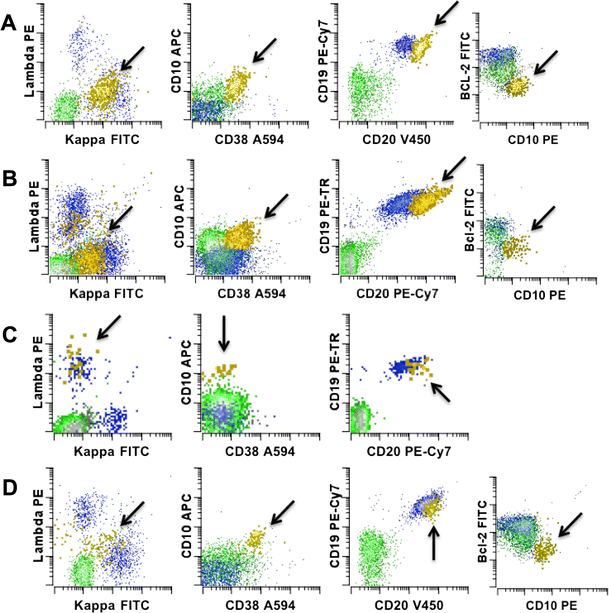 Significance of CD10-positive clonal B cell populations identified by ...