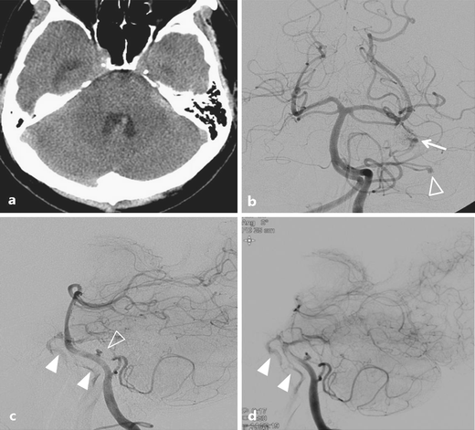 Ruptured Intrameatal Aneurysm of the Anterior Inferior Cerebellar ...