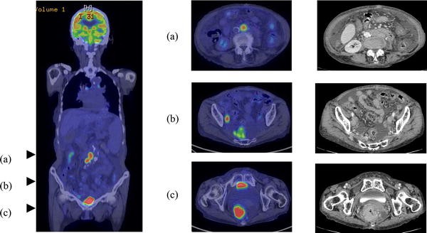 Primary rectal mucosa-associated lymphoid tissue lymphoma in a patient ...